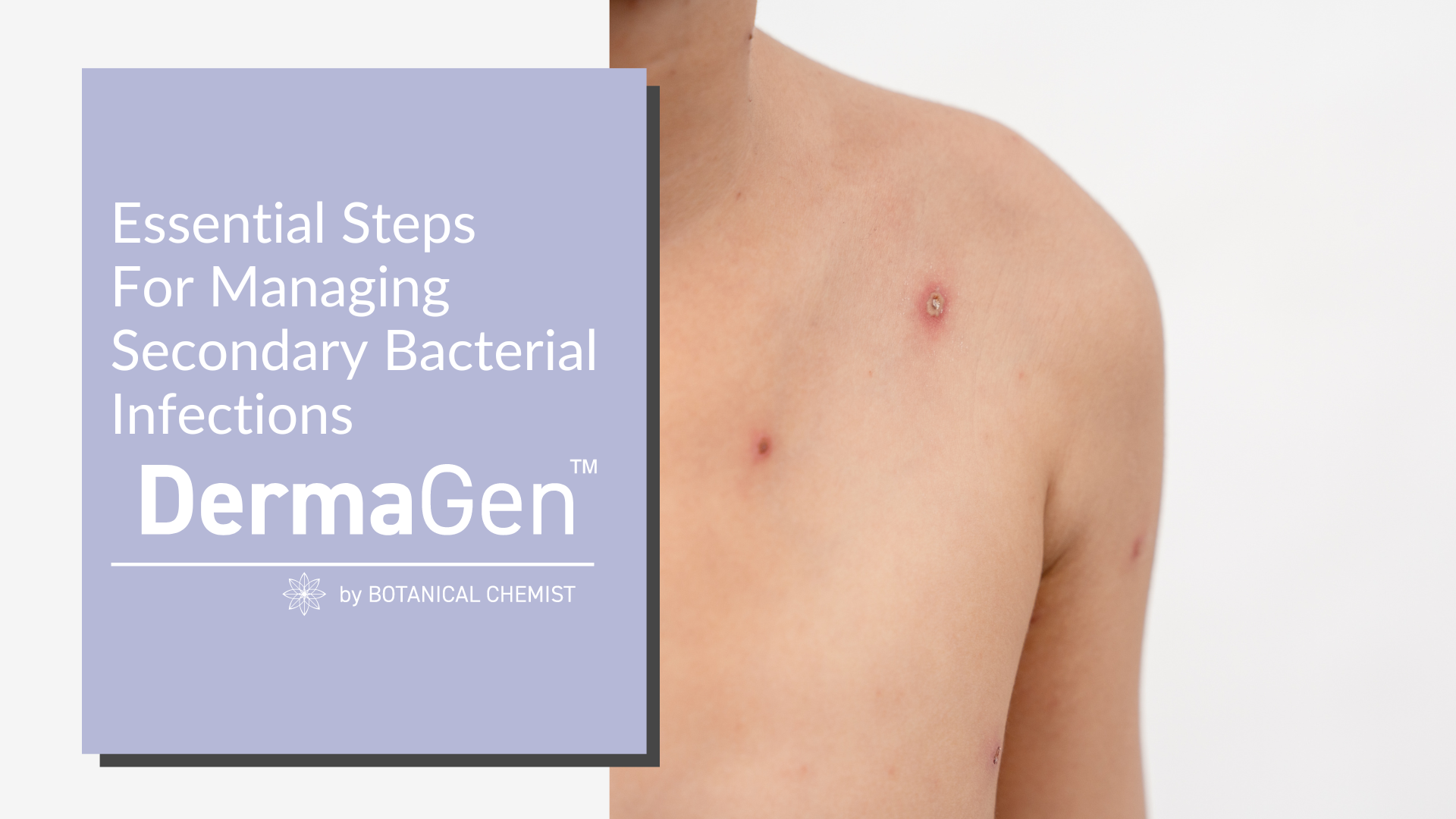 Essential Steps For Managing Secondary Bacterial Infections – DermaGen ...