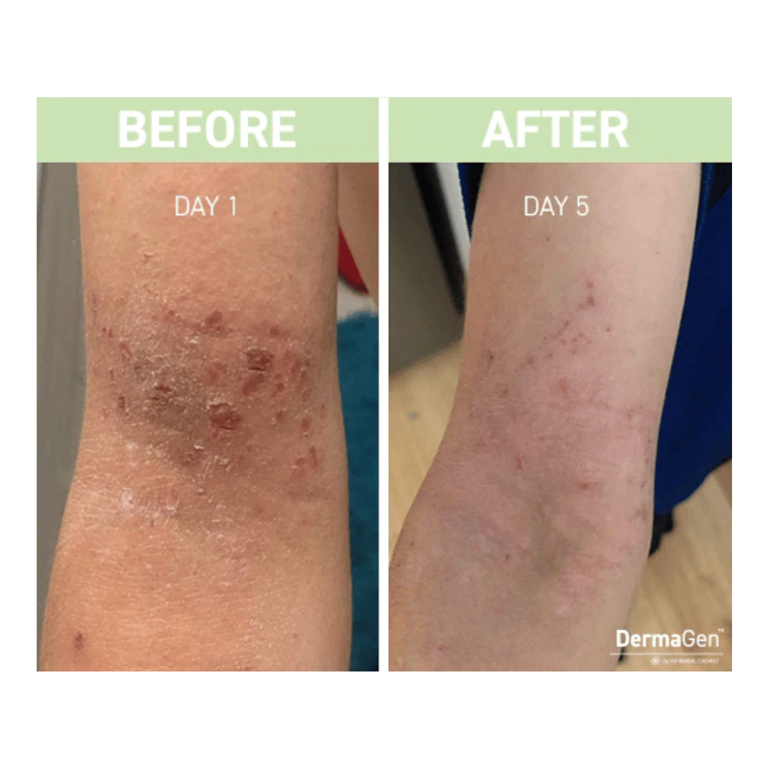 Topical Steroid Withdrawal: What you need to know – DermaGen by ...