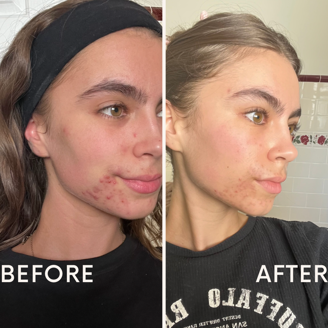 Acne, Pimples and Treatments – DermaGen by Botanical Chemist