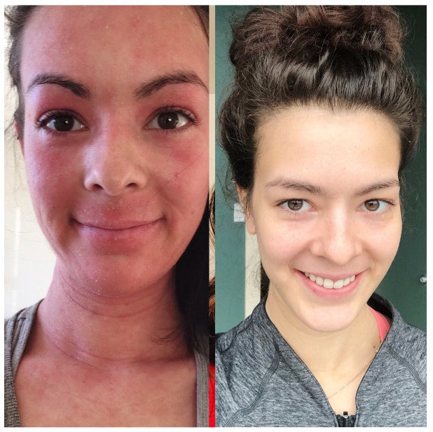 Topical Steroid Withdrawal: What you need to know – DermaGen by ...