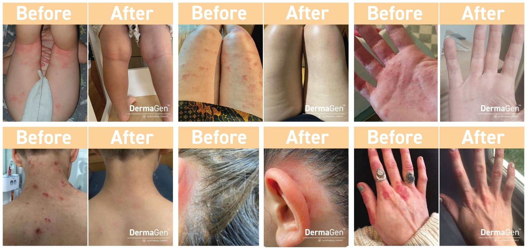 Topical Steroid Withdrawal: What you need to know – DermaGen by ...