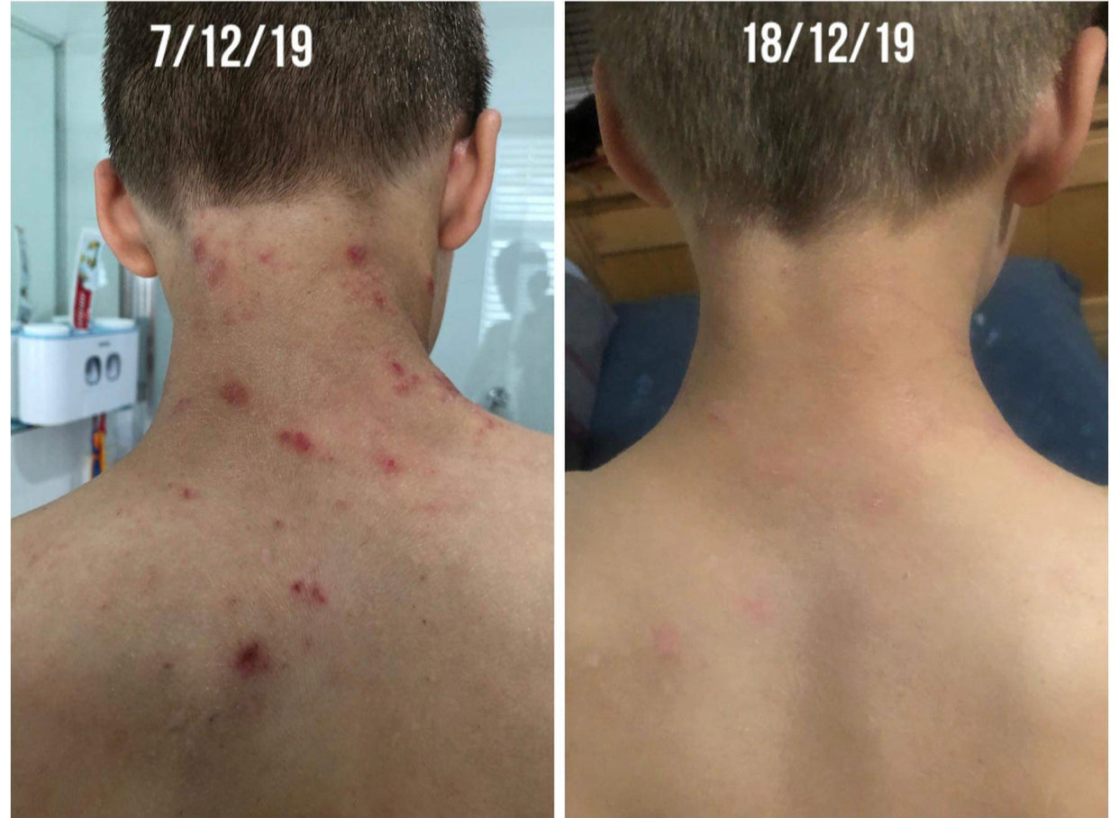 Topical Steroid Withdrawal: What you need to know – DermaGen by ...